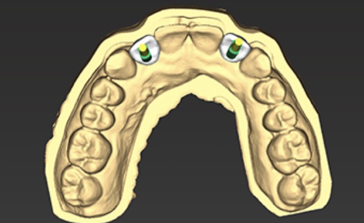 Surgical Guides - revealguides.com